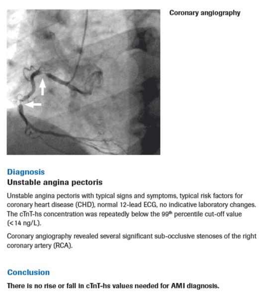 Serial testing of hs cTn rules out low risk of AMI - Cardio ThinkLab